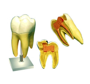 MAXILLARY MOLAR TOOTH WITH DENTAL CARIES - Almicroinstruments